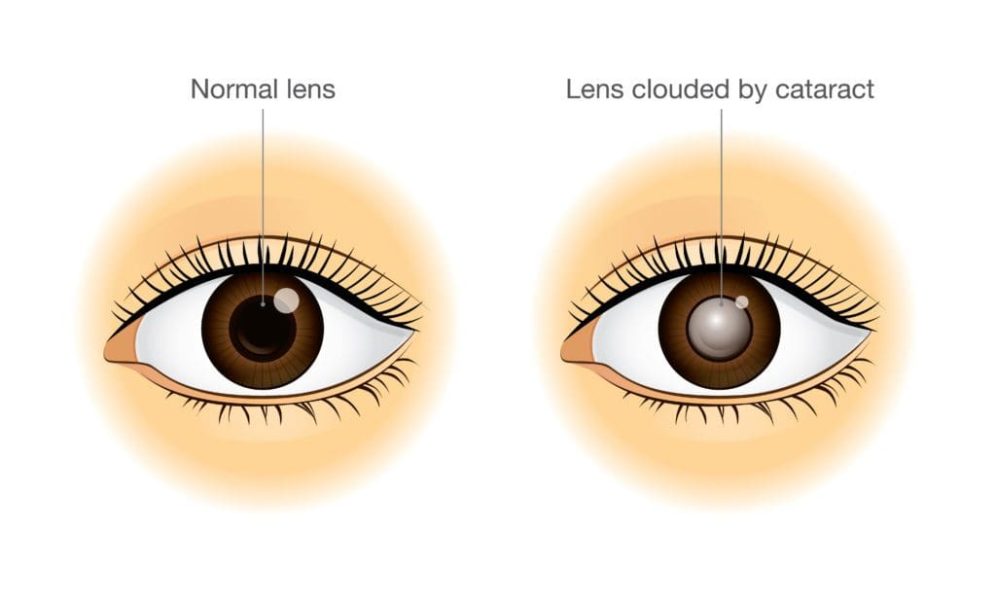 Understanding Cataracts: Causes, Symptoms, and Diagnosis
